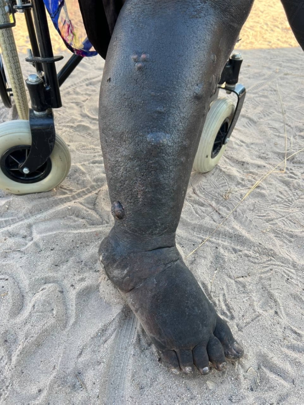 Woman in agony after snake bite 9 years ago - Namibian Sun